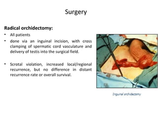 Management of testicular cancers | PPT