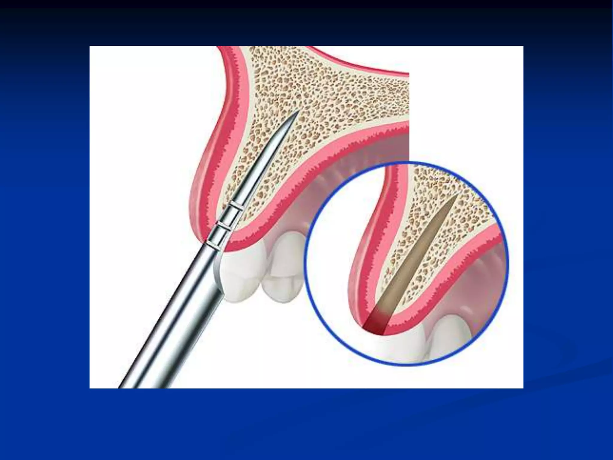 Ridge Expansion Illustration | PPT