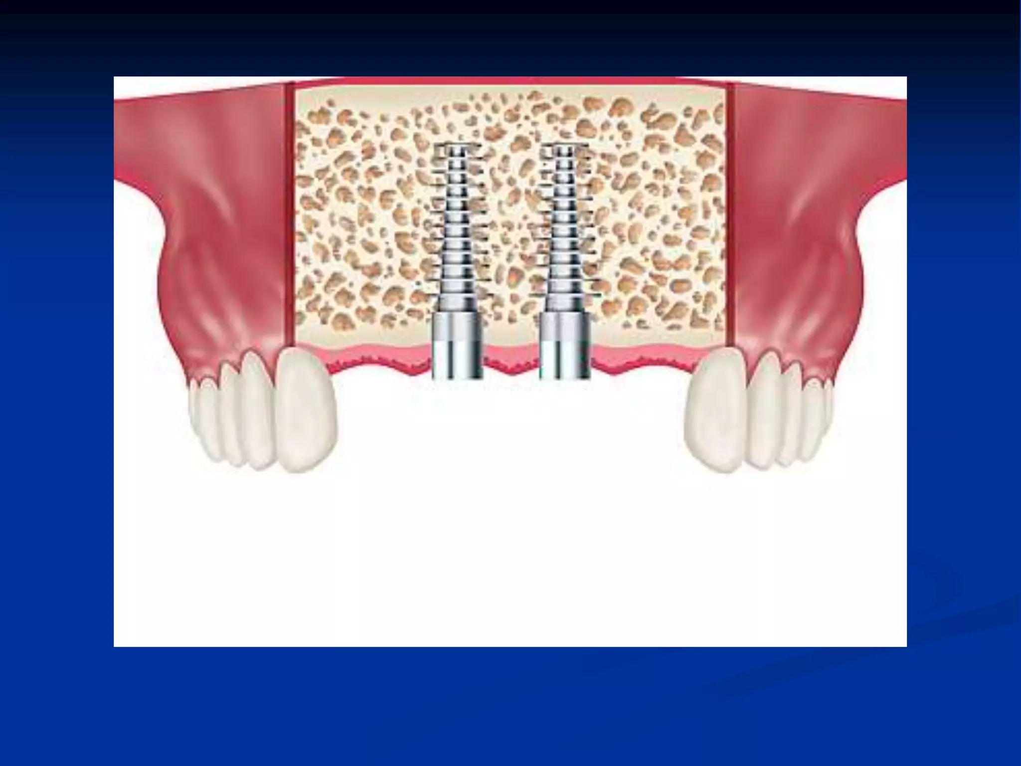 Ridge Expansion Illustration | PPTX