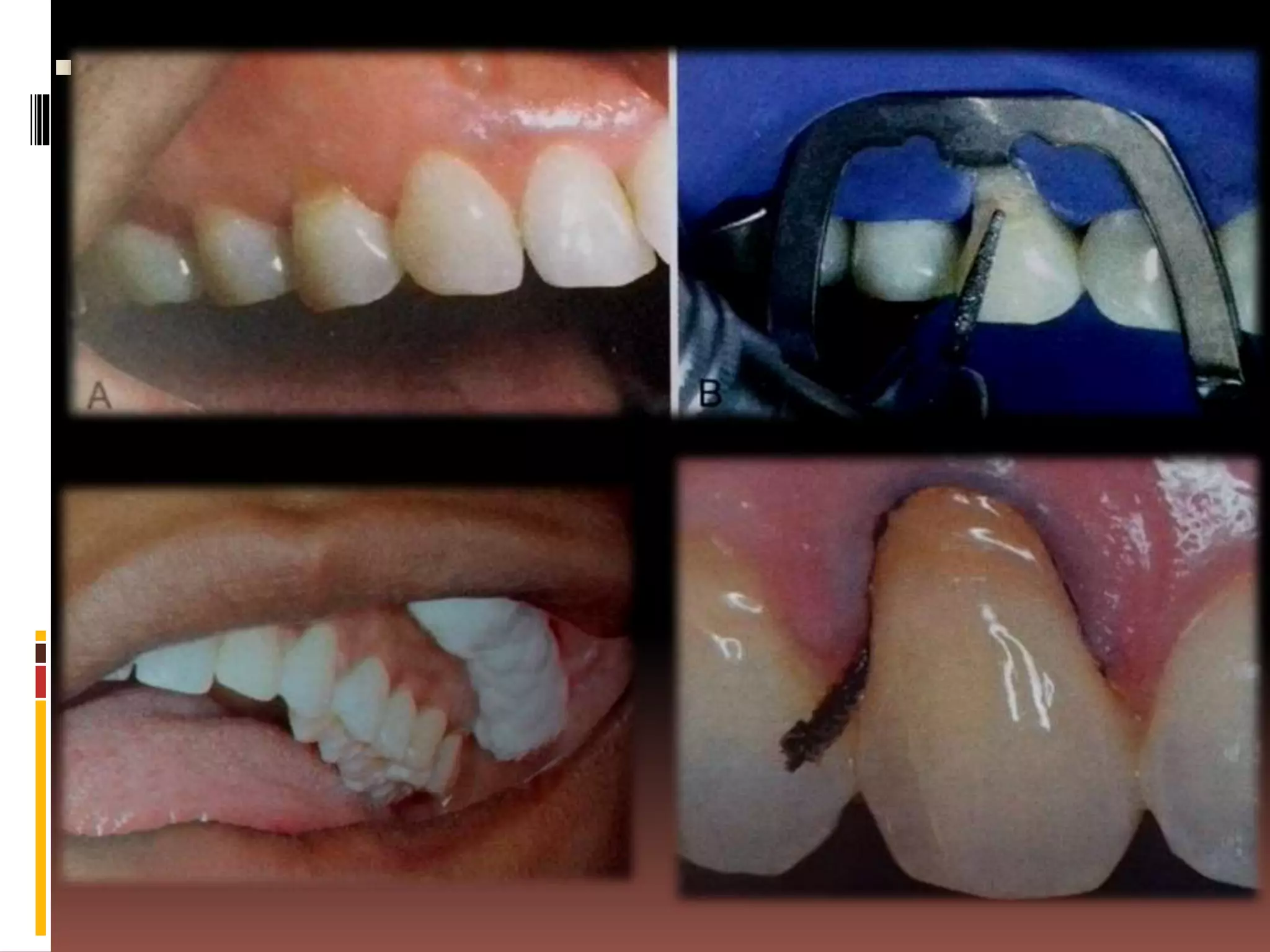 Management of class V caries | PPTX