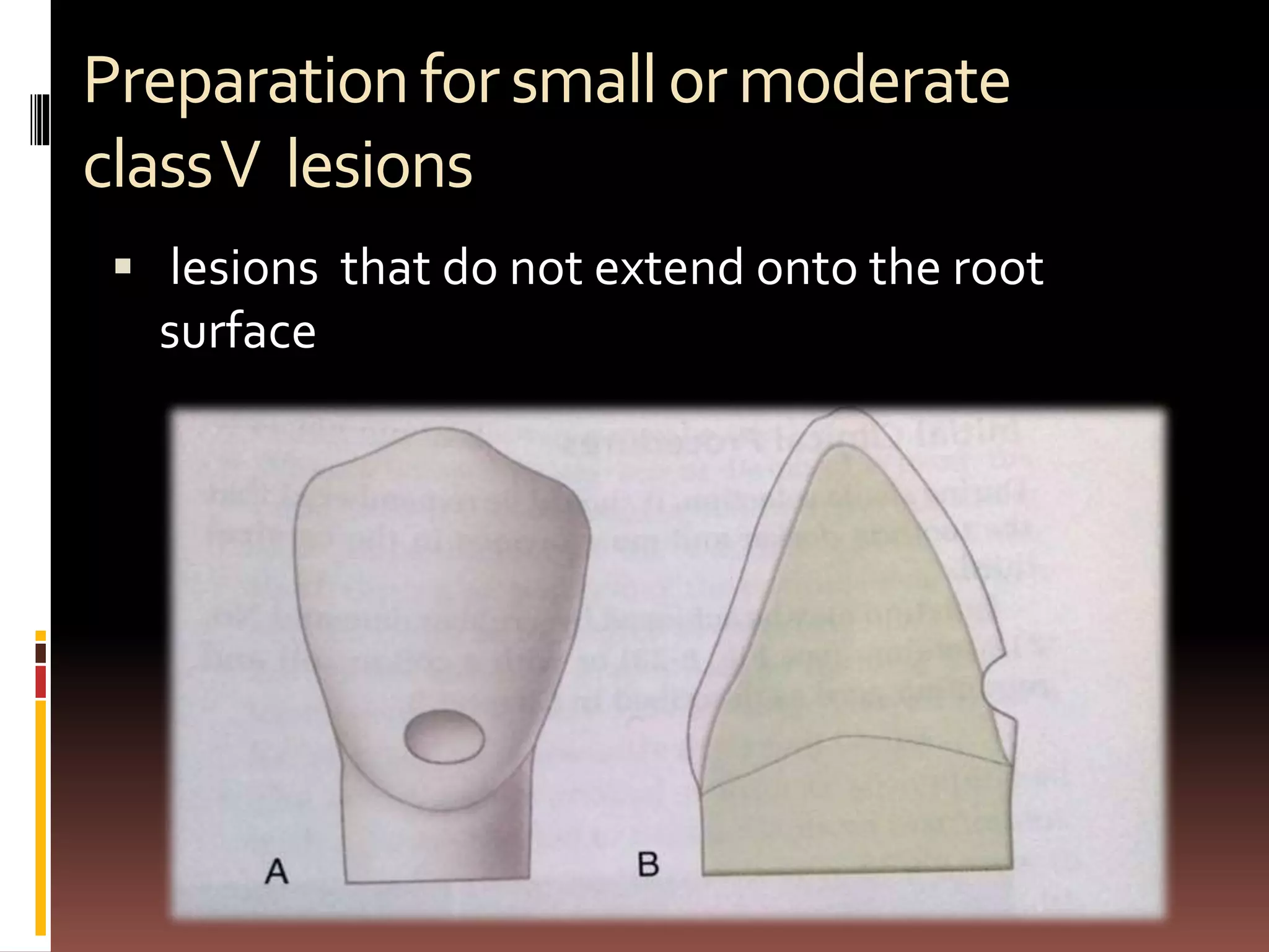 Management of class V caries | PPTX