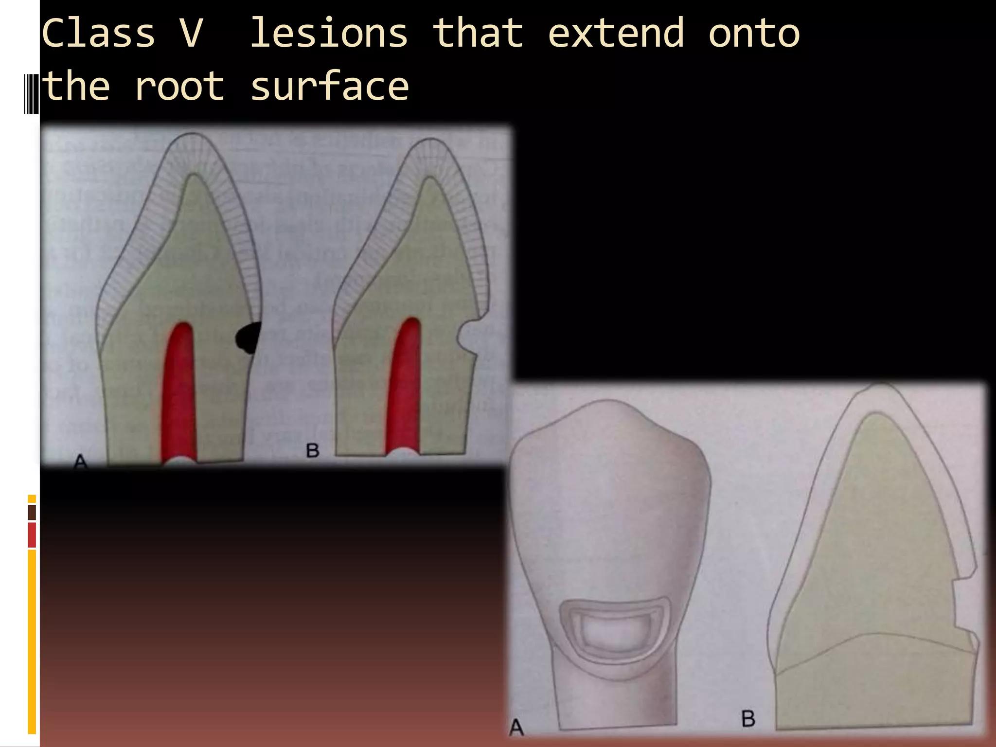 Management of class V caries | PPTX
