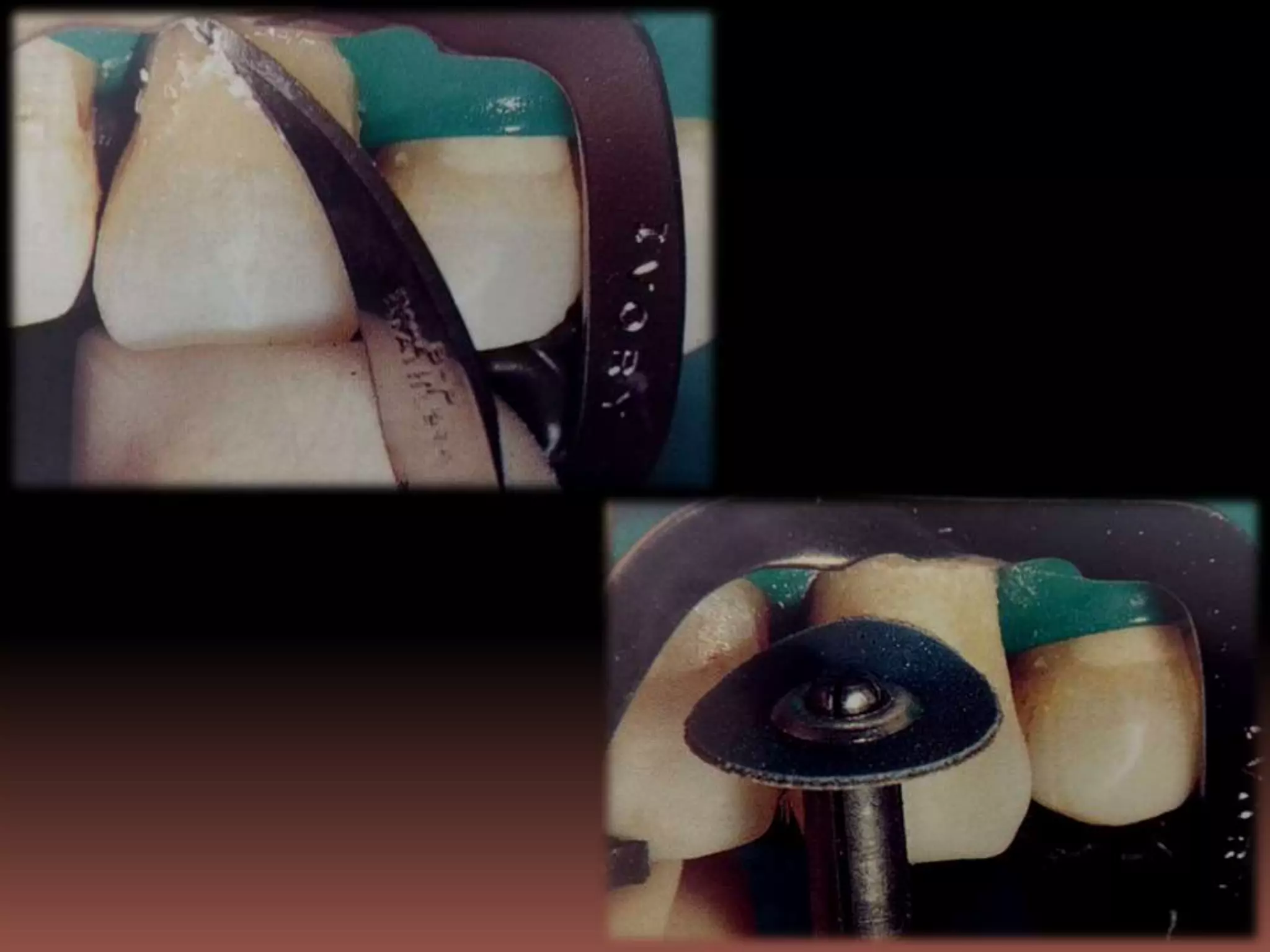 Management of class V caries | PPTX