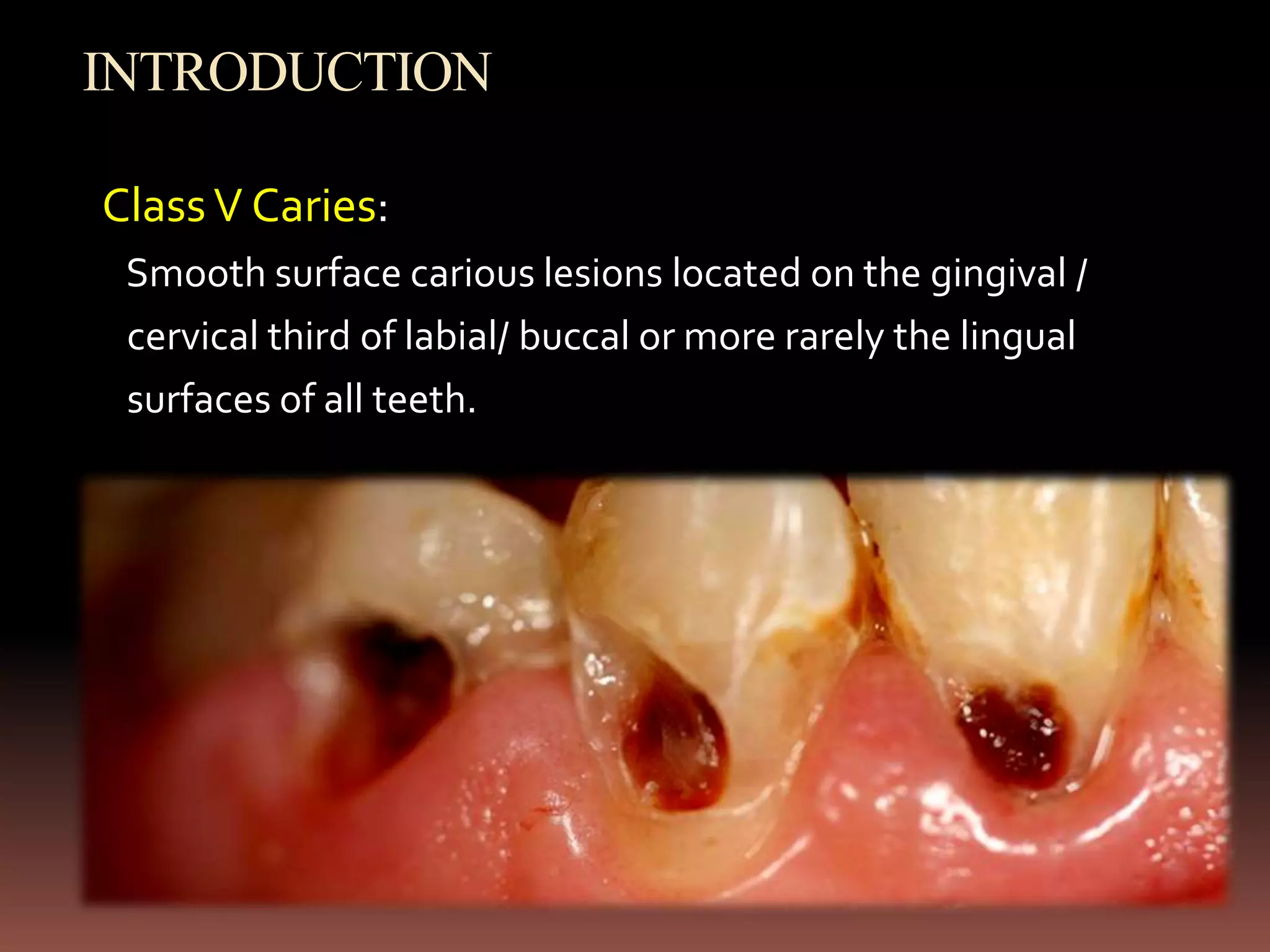 Management of class V caries | PPTX