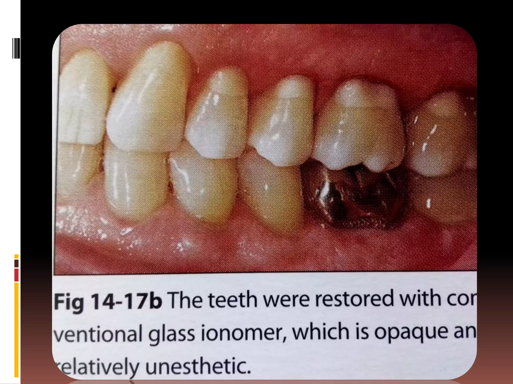 Management of class V caries | PPTX