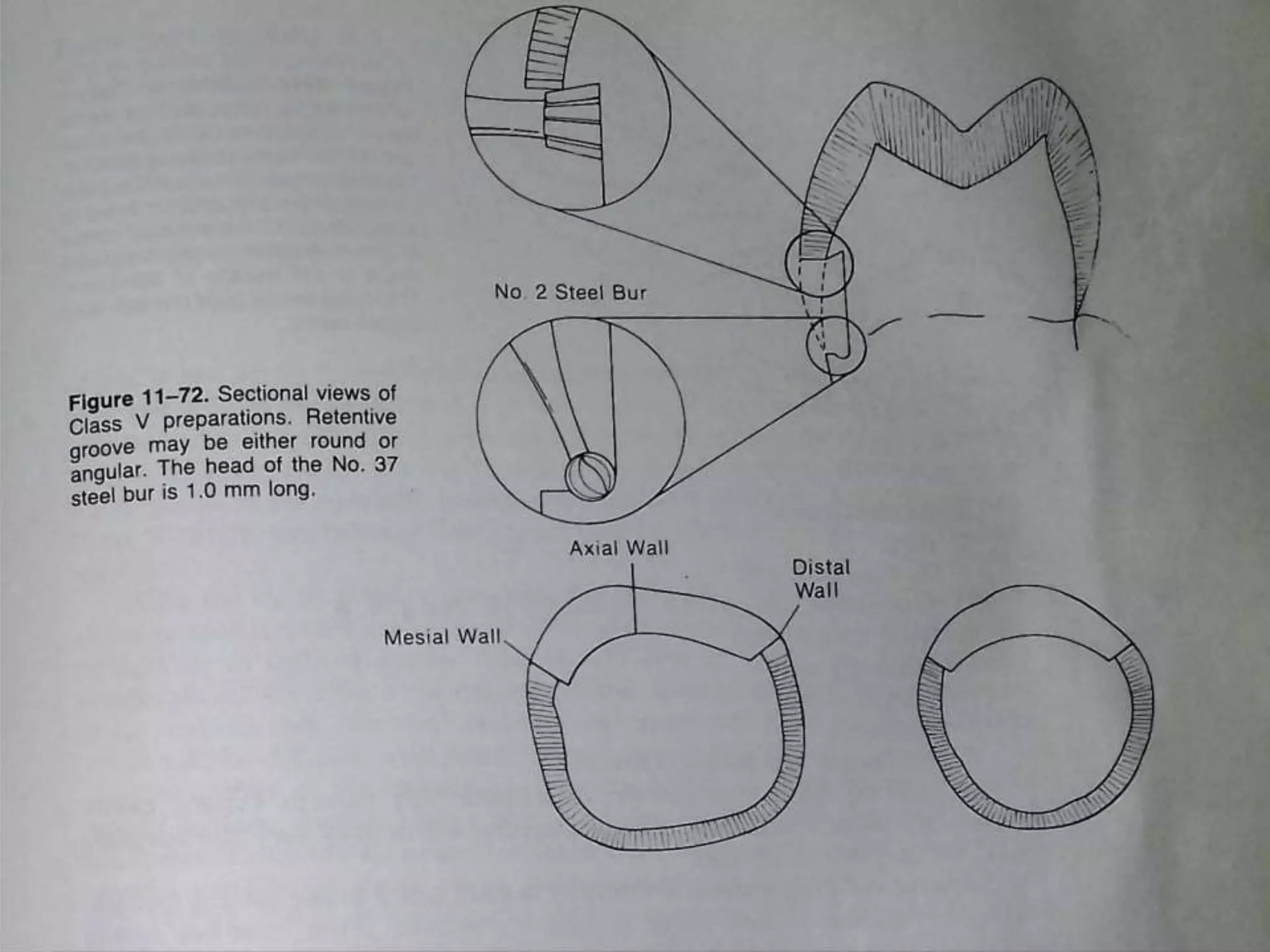 Management of class V caries | PPTX