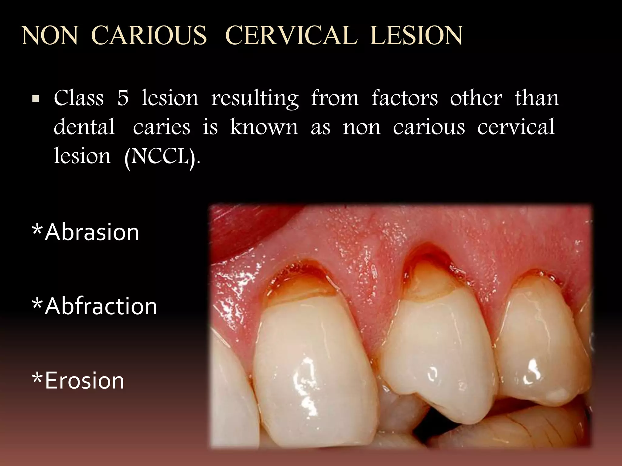 Management of class V caries | PPTX