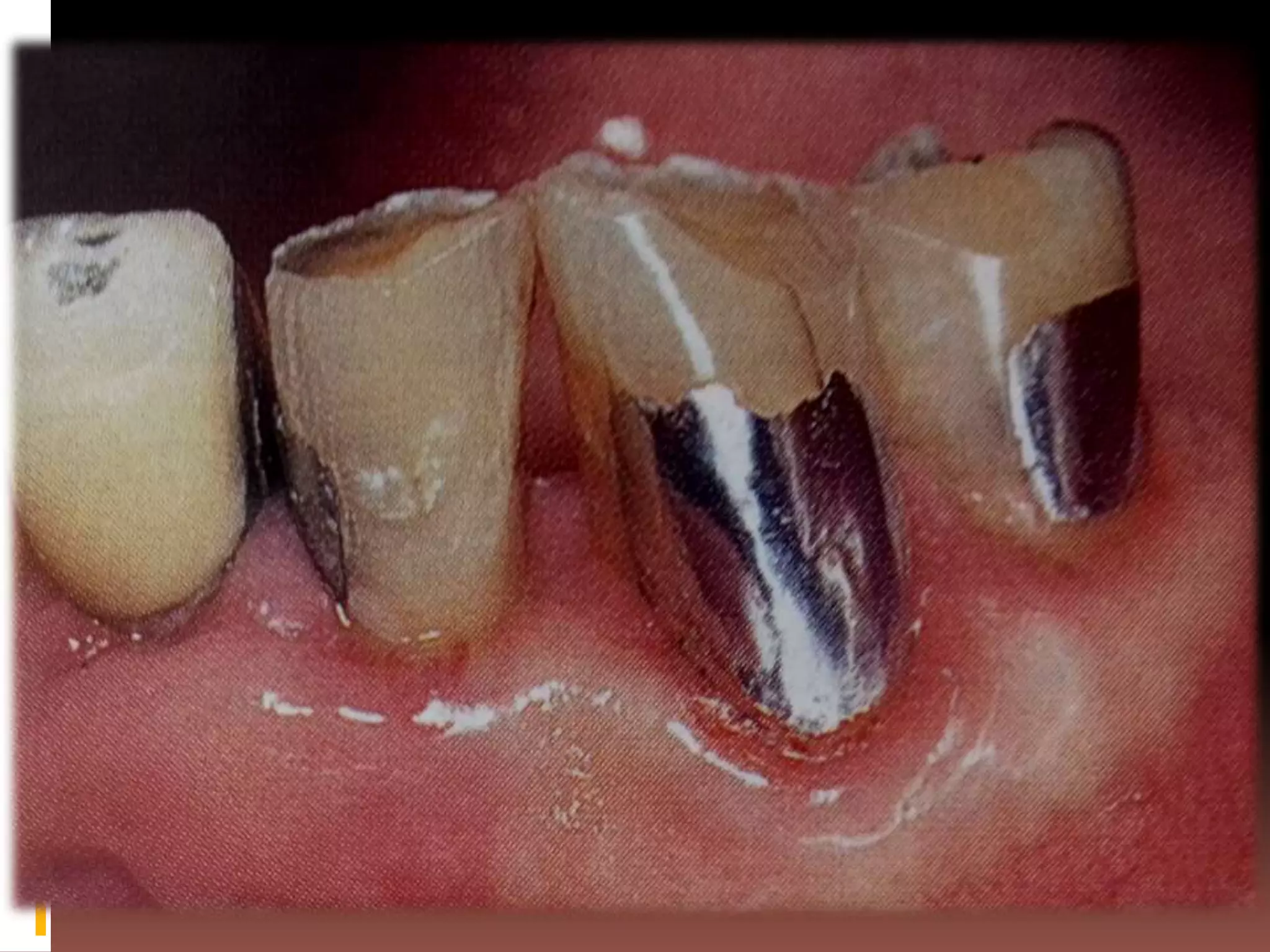Management of class V caries | PPTX