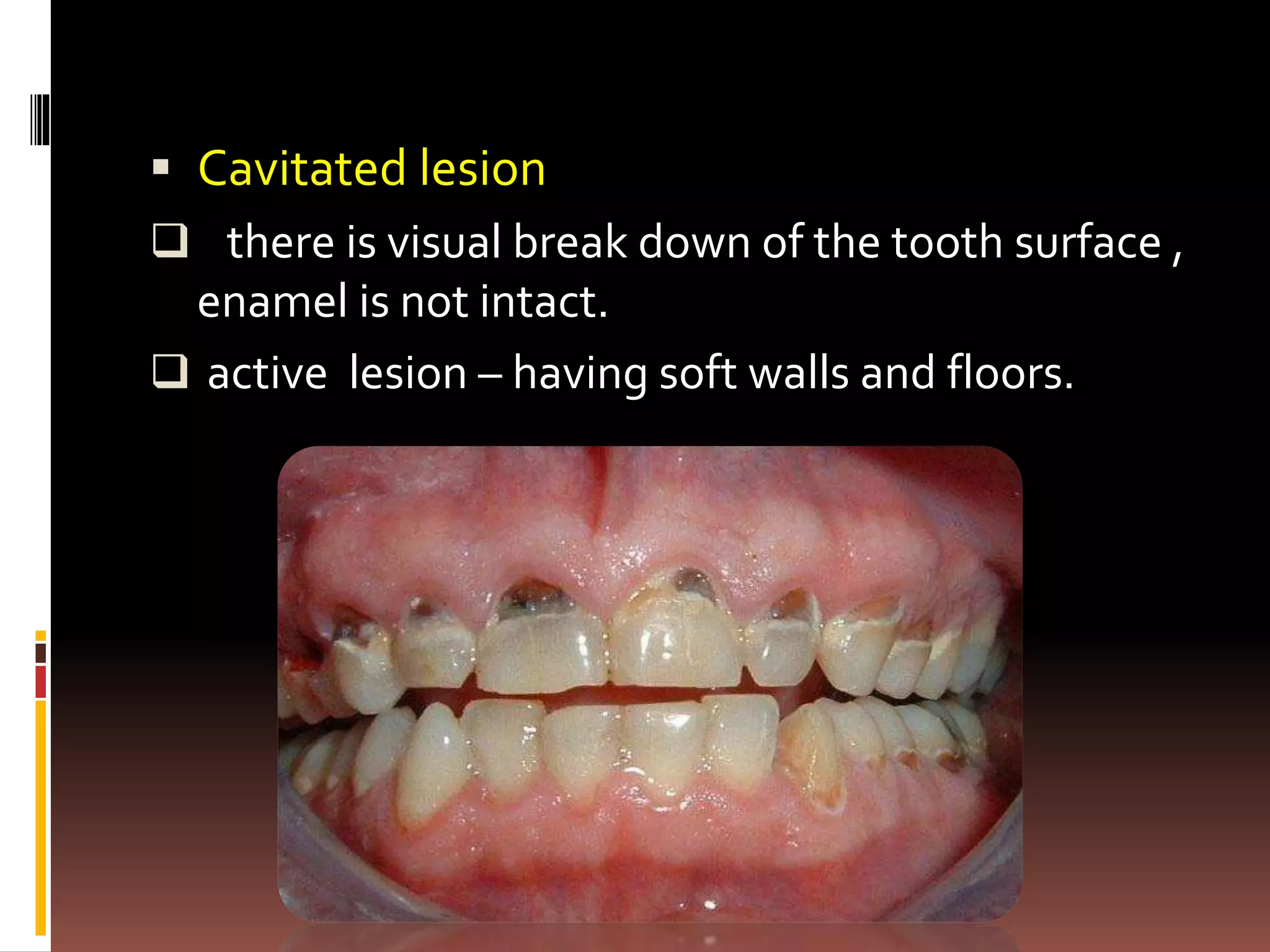 Management of class V caries | PPTX