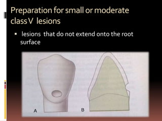 Management of class V caries | PPTX