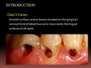 Management of class V caries | PPTX