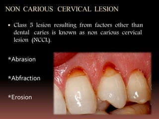 Management of class V caries | PPTX