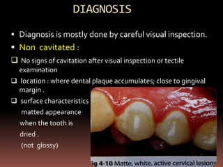 Management of class V caries | PPTX