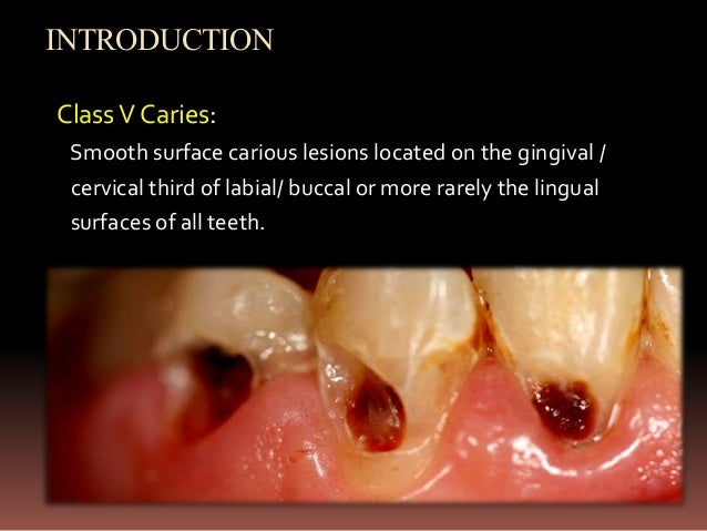 Management of class V caries
