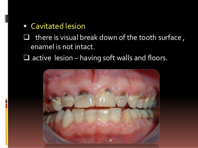 Management of class V caries