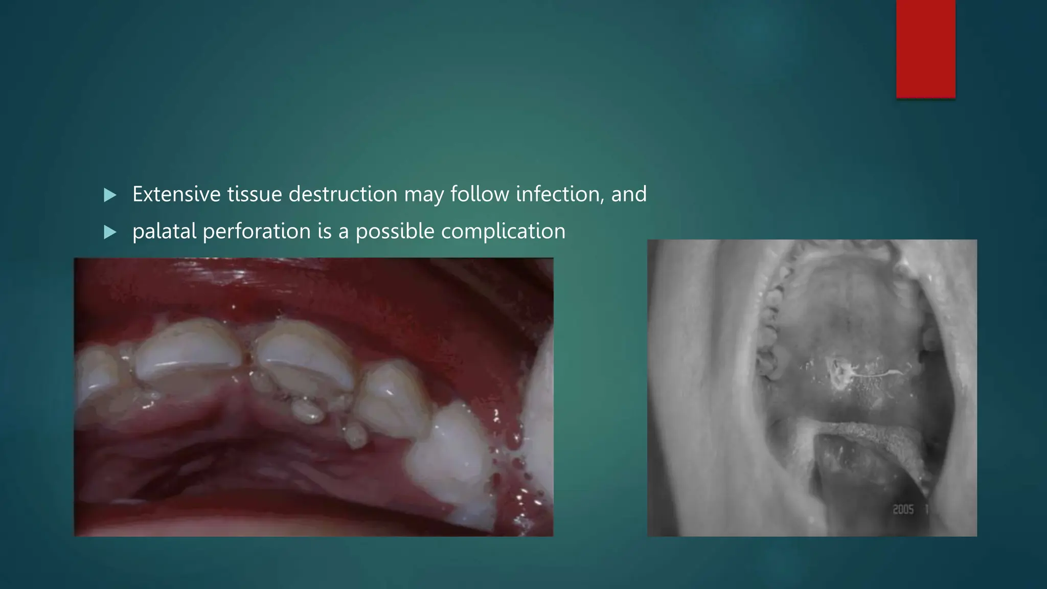 Myiasis in Ear Nose Throat and HNS .pptx