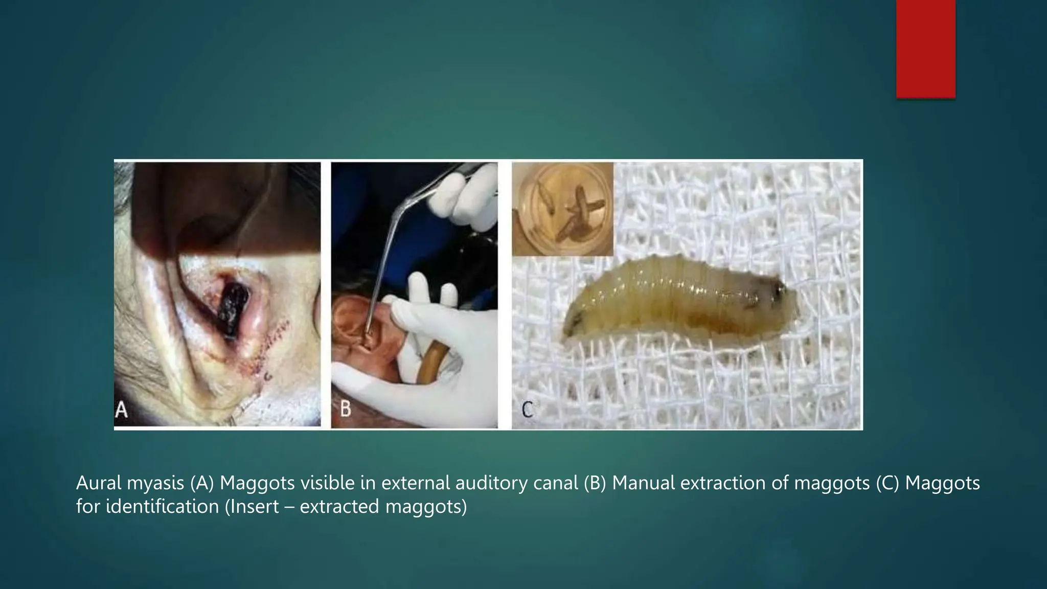 Myiasis in Ear Nose Throat and HNS .pptx