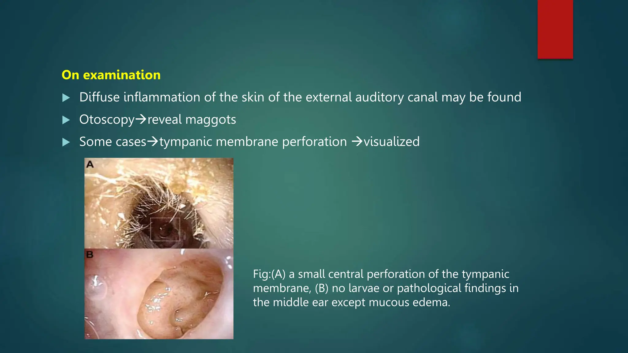 Myiasis in Ear Nose Throat and HNS .pptx