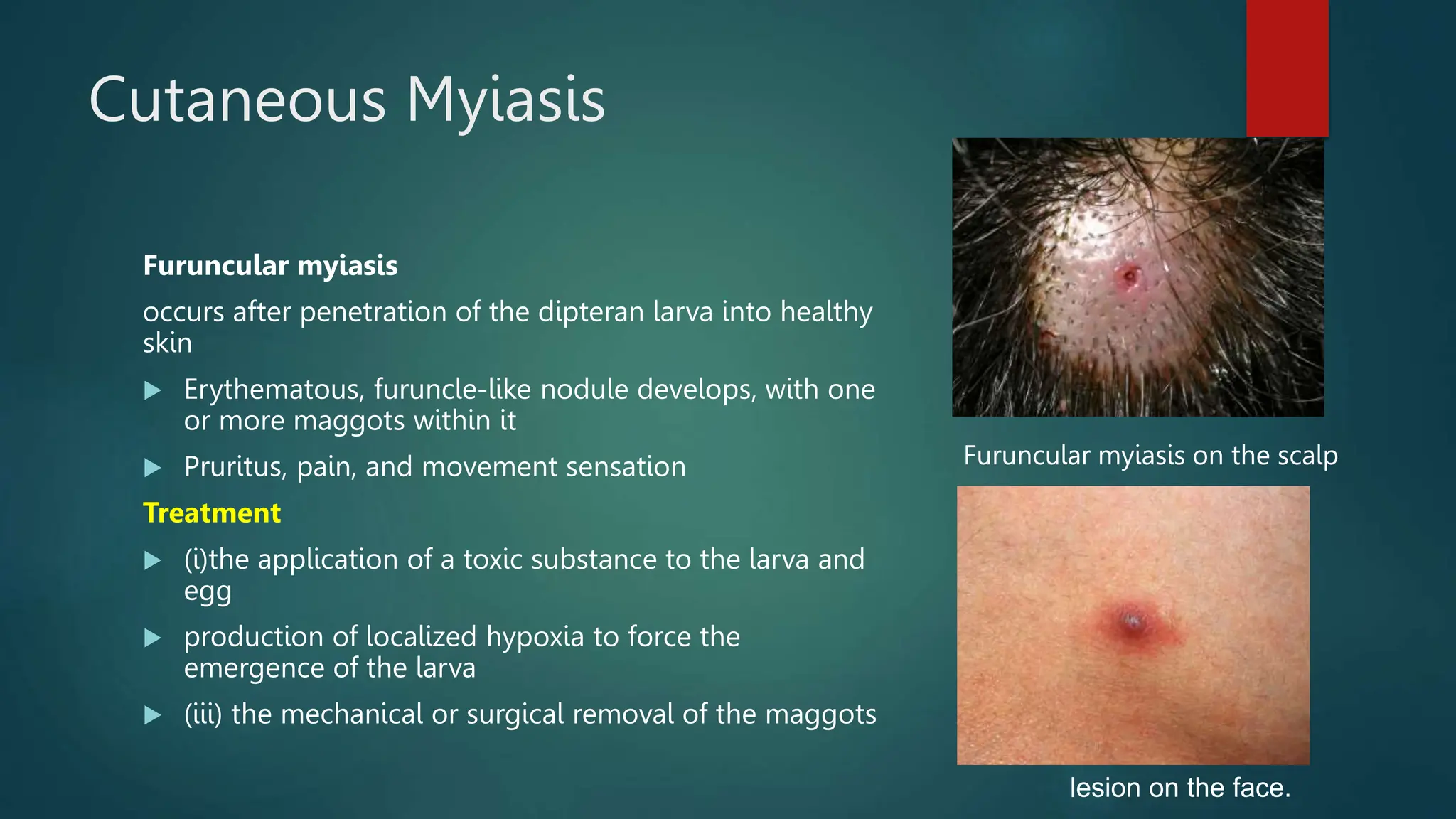 Myiasis in Ear Nose Throat and HNS .pptx