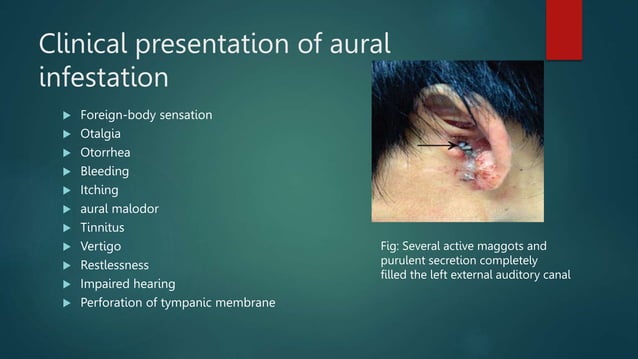 Myiasis in Ear Nose Throat and HNS .pptx