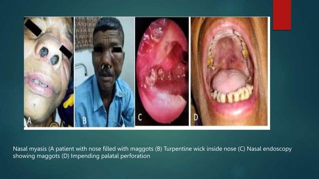 Myiasis in Ear Nose Throat and HNS .pptx