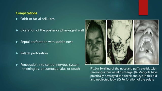 Myiasis in Ear Nose Throat and HNS .pptx