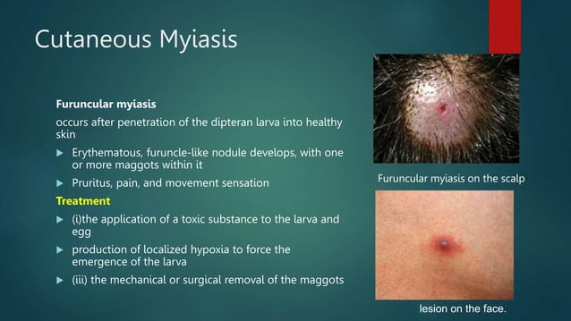 Myiasis in Ear Nose Throat and HNS .pptx