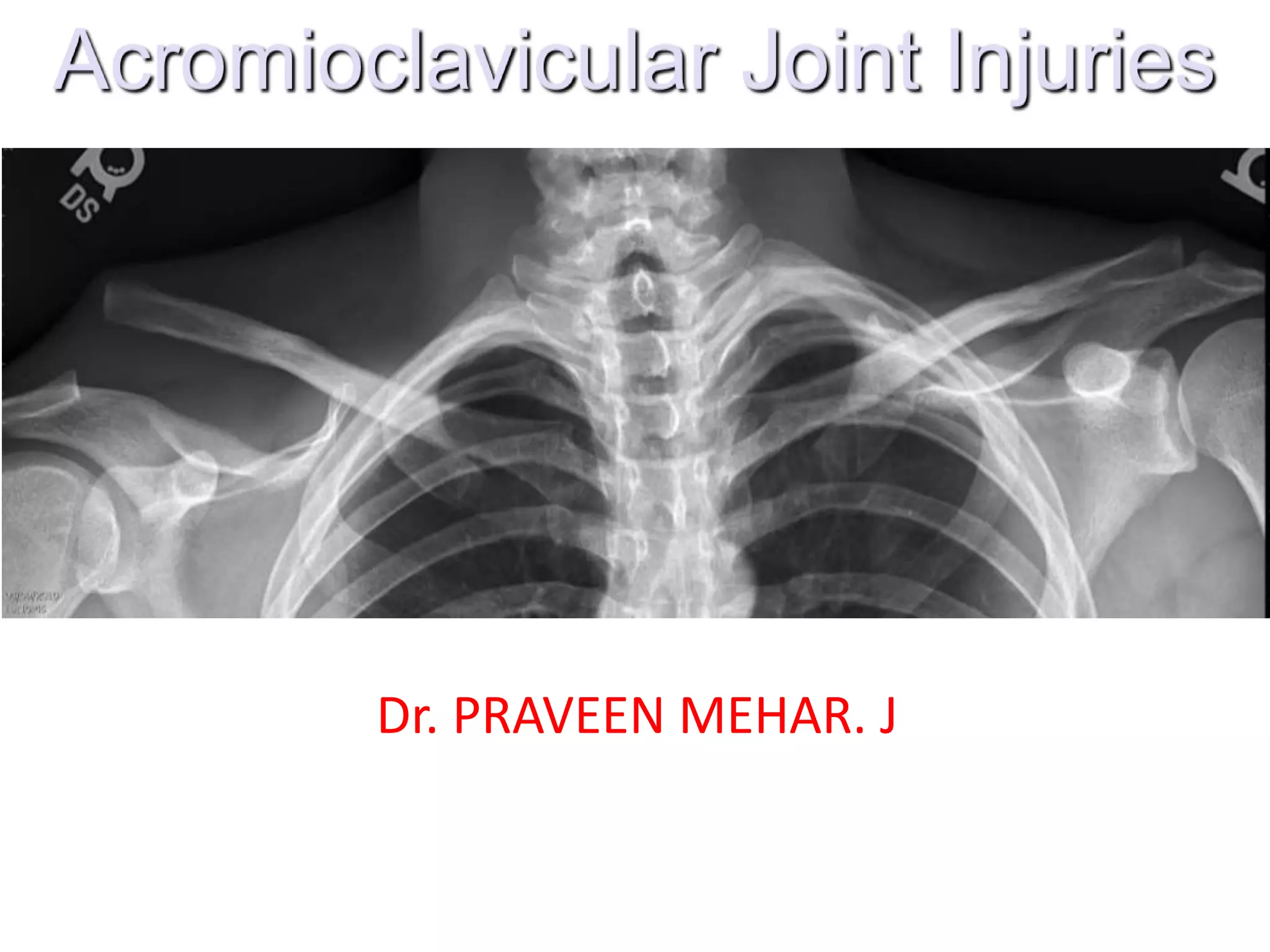 My ac joint injuries presentation1 | PPTX | Death, Injury, or Military ...