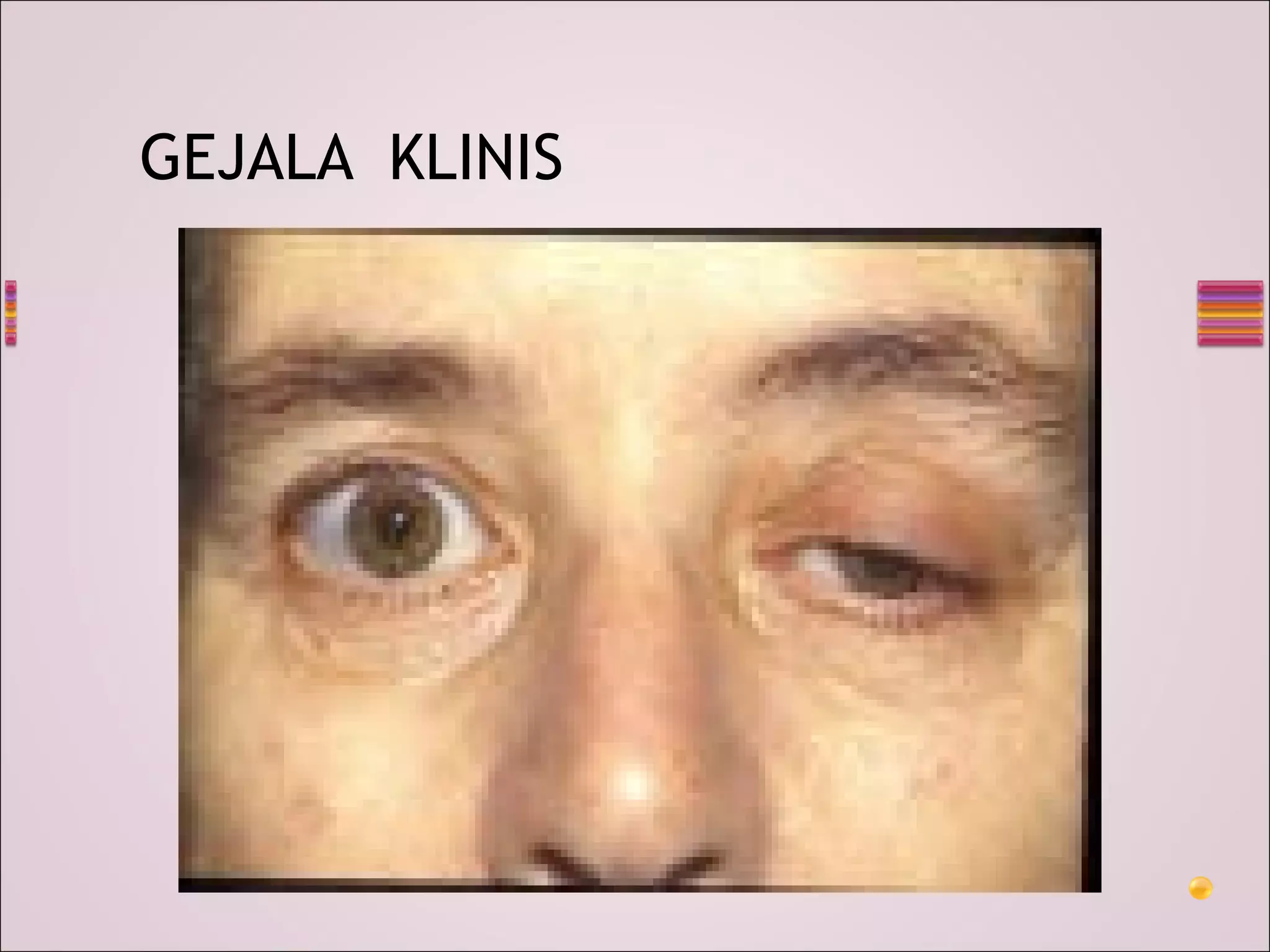 Myastenia gravis-ppt | PPT