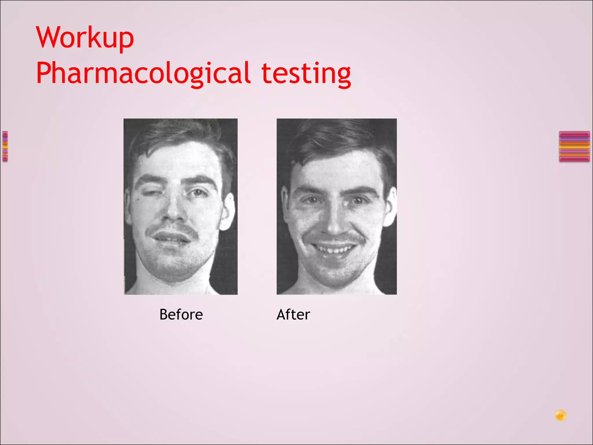 Myastenia gravis-ppt | PPT