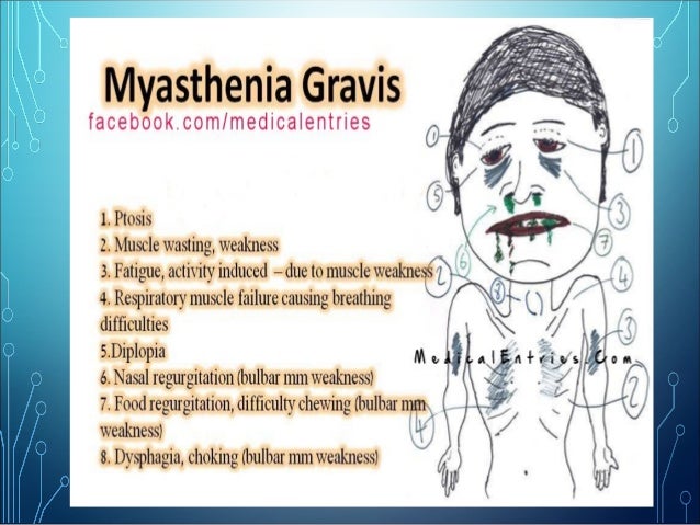 myasthenia gravis