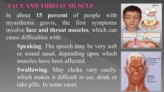 Myasthenia gravis | PPTX