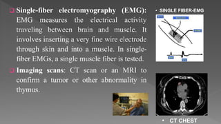 Myasthenia gravis | PPTX