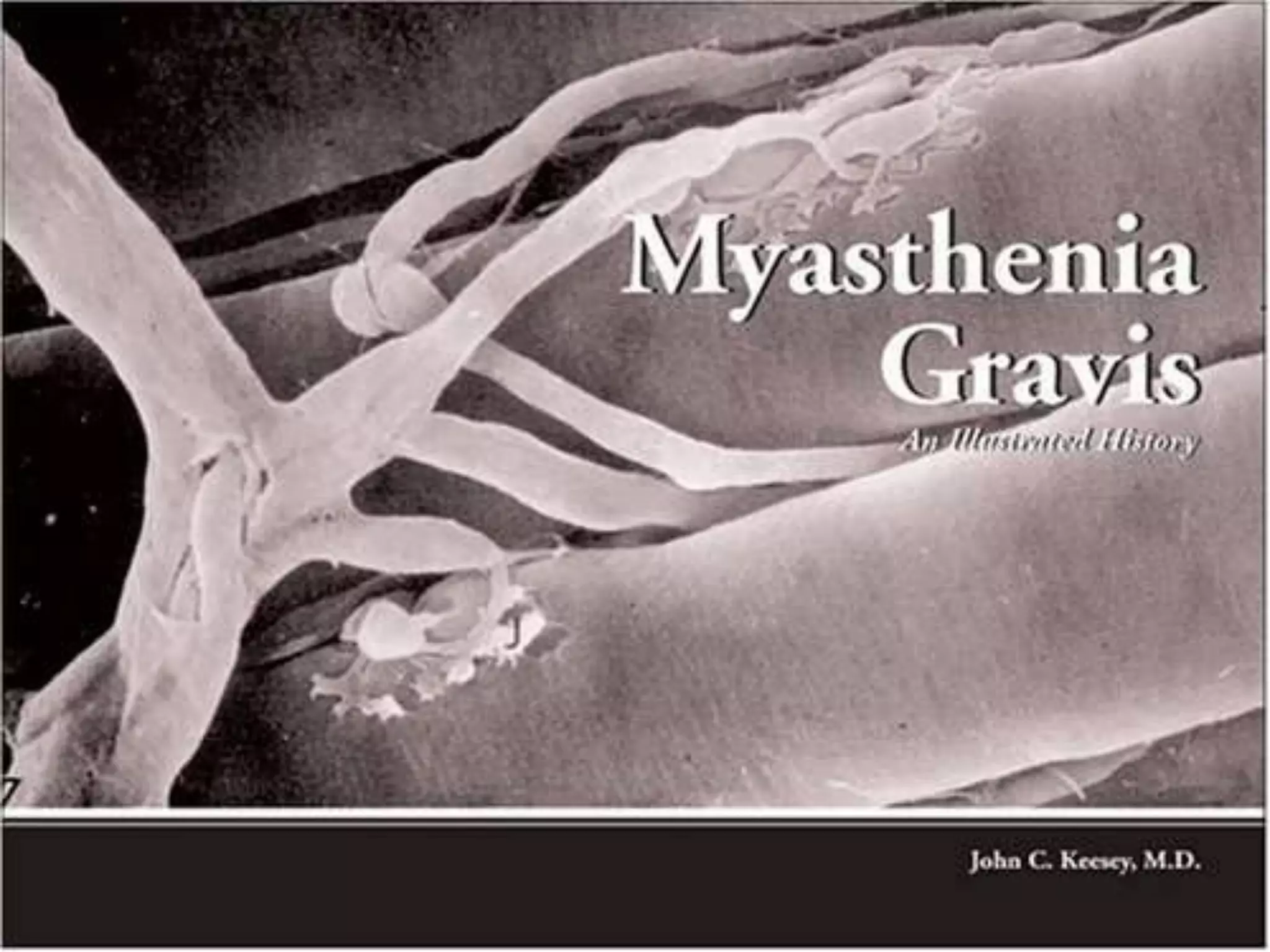 Myasthenia gravis ppt immunology | PPTX