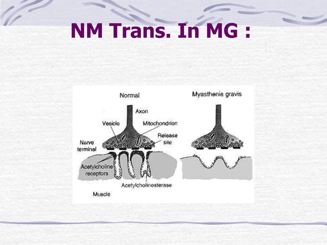 Myasthenia gravis ppt immunology | PPT