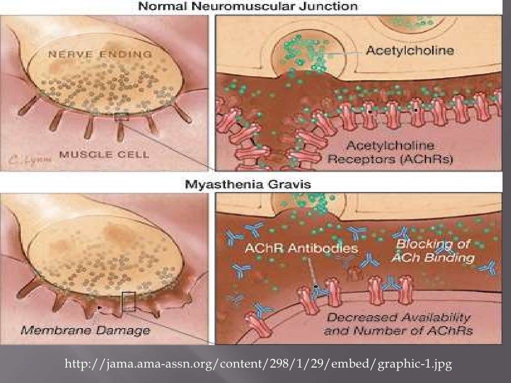 Myasthenia gravis
