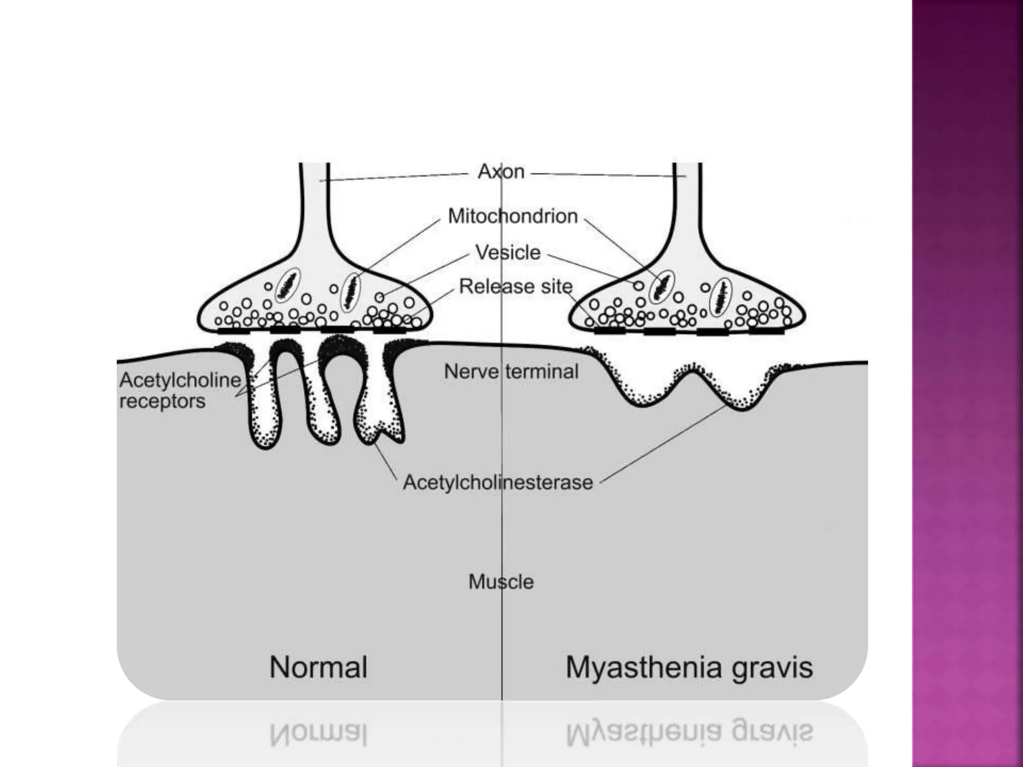 MYASTHENIA GRAVIS | PPSX