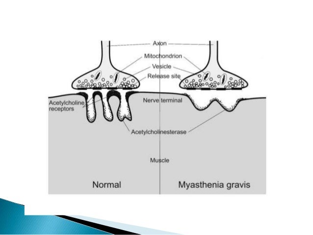 Myasthenia gravis | PPT