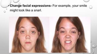 Myasthenia gravis | PPTX