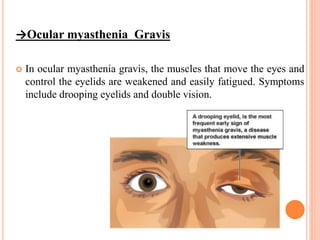 Myasthenia gravis | PPTX
