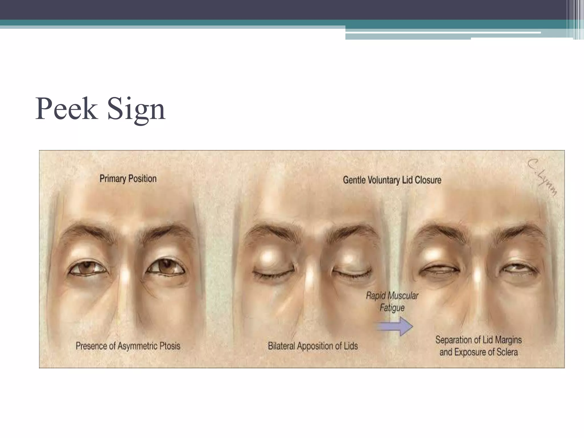 Myasthenia Gravis | PPTX
