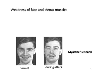 myasthenia gravis.pdf