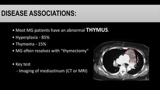MYASTHENIA GRAVIS - by Shanmukh Tunuguntla | PPTX