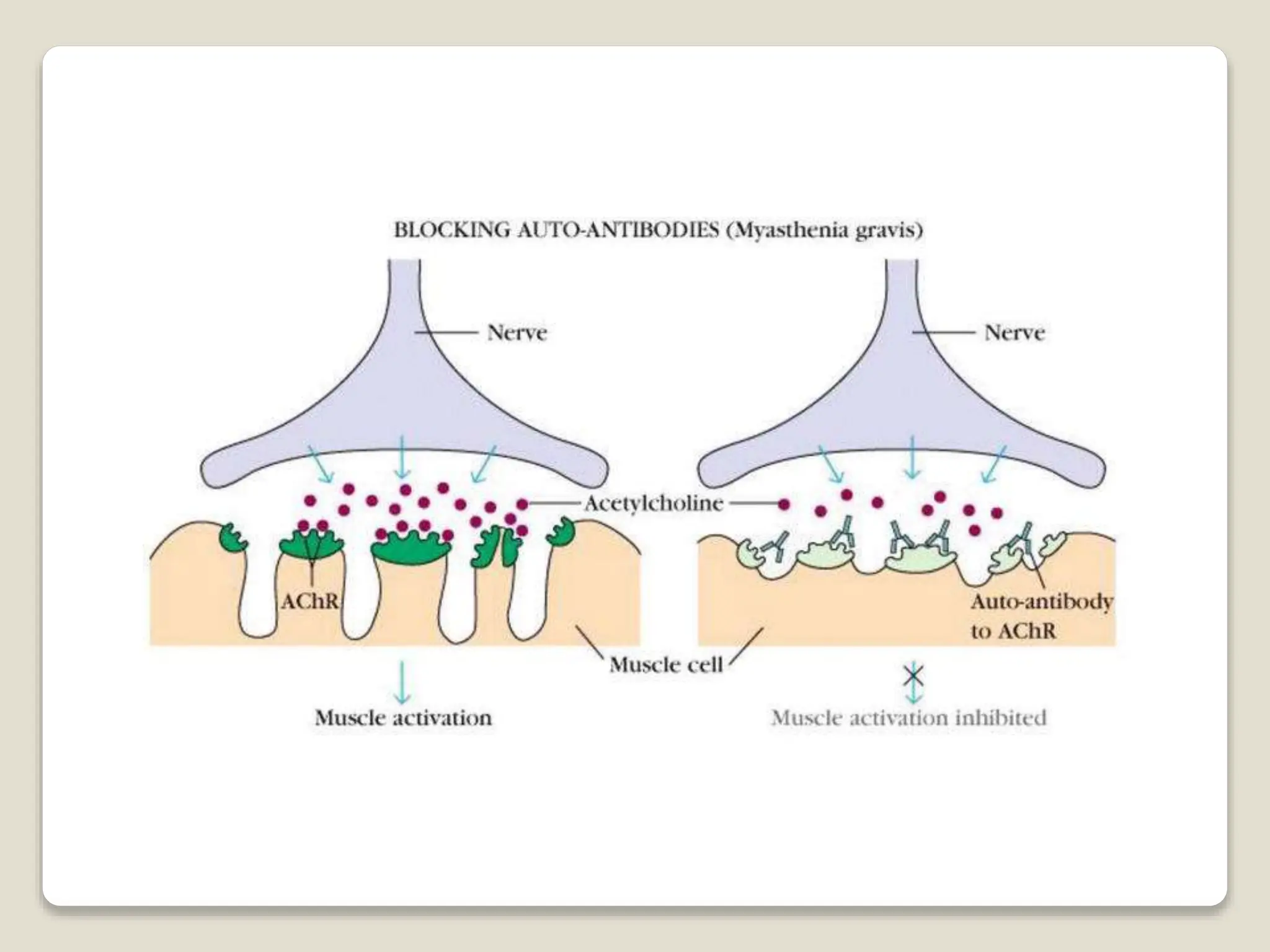 MYASTHENIA GRAVIS: etiology, pathophysiology, clinical manifestations ...