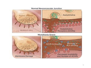 Myasthenia Gravis case presentation pptn | PPTX | Eye and Vision ...