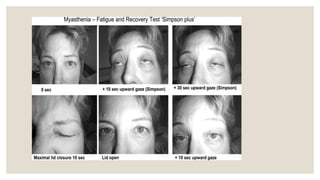 Myasthenia gravis signs and symptoms.pptx