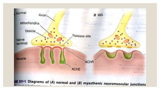 Myasthenia gravis signs and symptoms.pptx