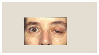 Myasthenia gravis signs and symptoms.pptx