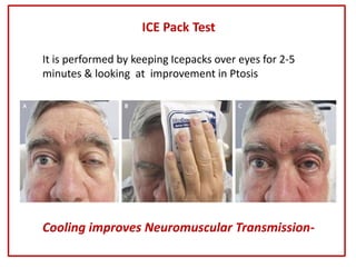 Myasthenia gravis teaching..Dr M D Mohire, Kolhapur,Maharashtra | PPT