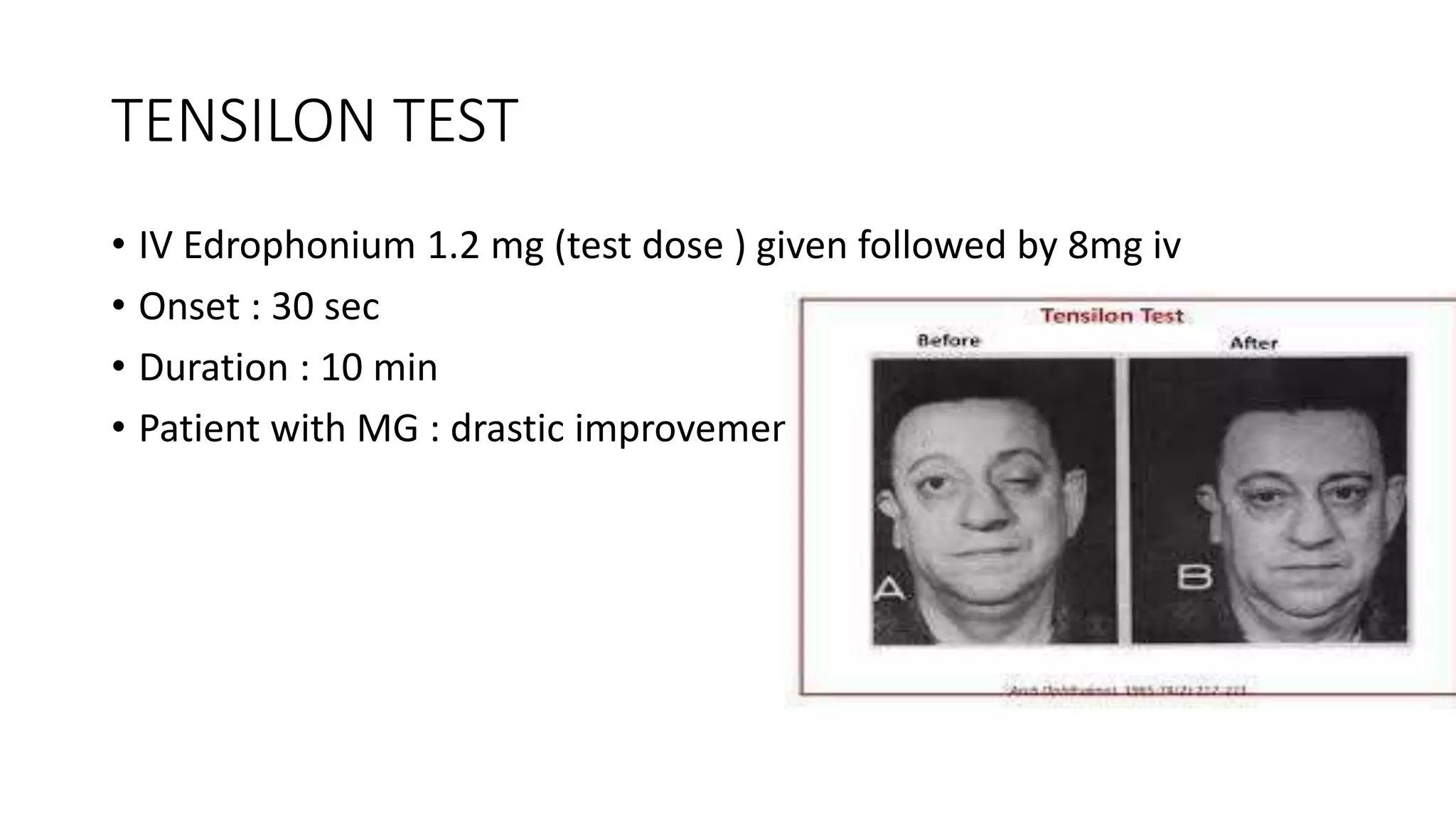 Myasthenia gravis and anaesthesia | PPTX